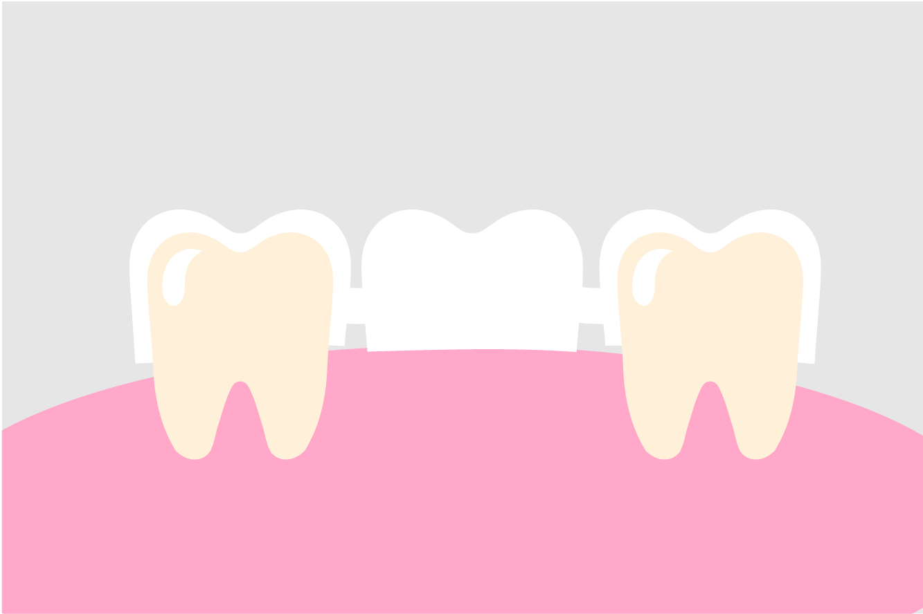 Dental Bridges in Holly, MI - Merit Dental